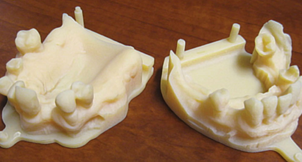 Digital Impressions for an Immediate Denture