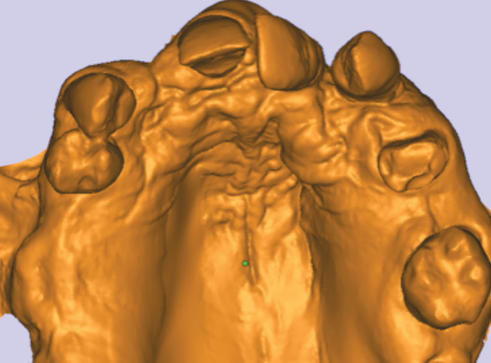 Digital Impressions for an Immediate Denture