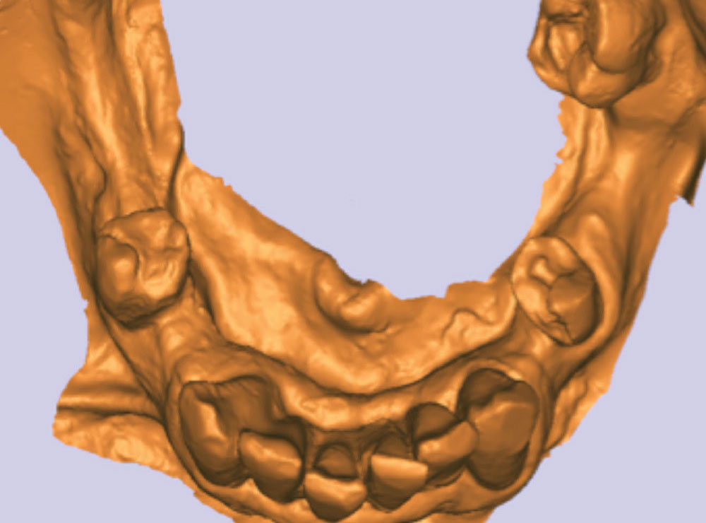 Digital Impressions for an Immediate Denture