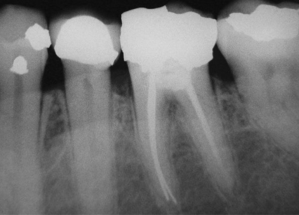 Is It Time to Do Routine Adult Pulpotomies?