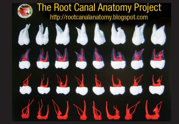 Is It Time to Do Routine Adult Pulpotomies?