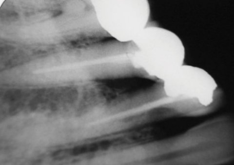 Is It Time to Do Routine Adult Pulpotomies?