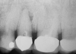 Is It Time to Do Routine Adult Pulpotomies?