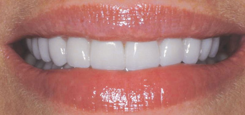 Upgrading Porcelain Veneer Restorations: A Case Report