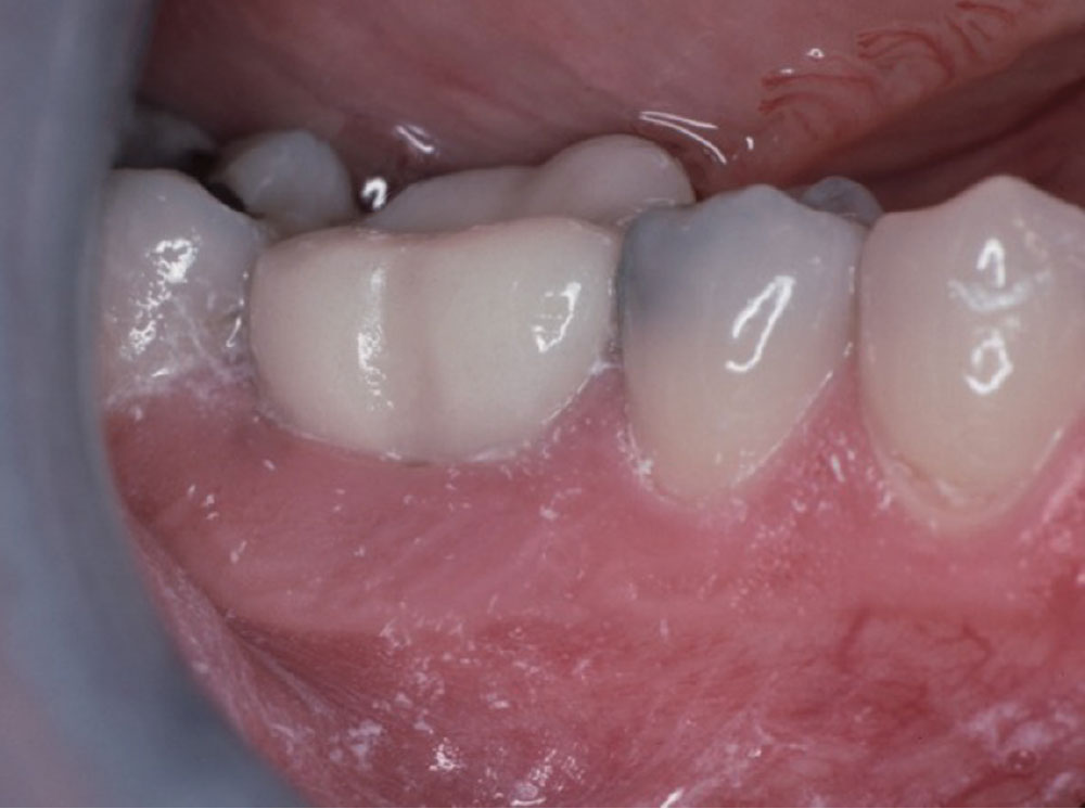 Biologic Shaping: An Alternative to Extracting a Tooth with a Severe ...