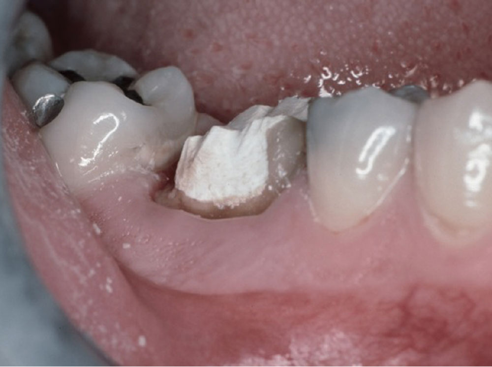 Biologic Shaping: An Alternative to Extracting a Tooth with a Severe ...