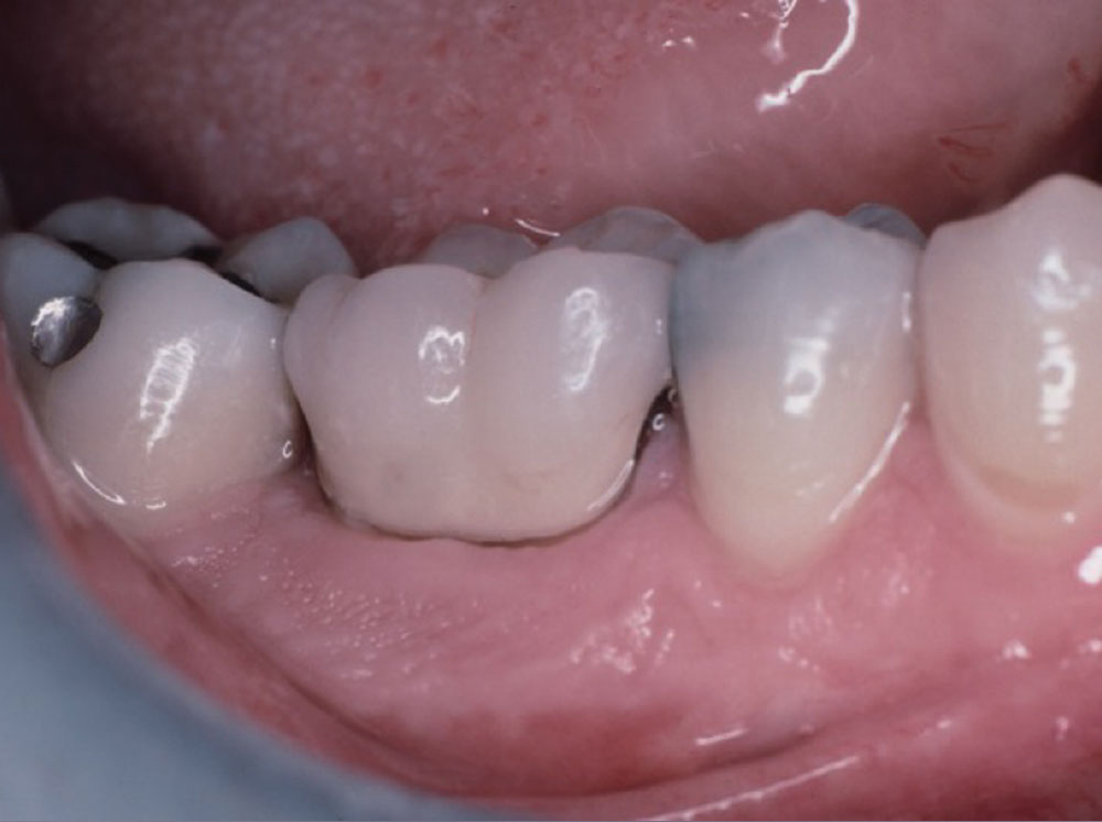 Biologic Shaping: An Alternative to Extracting a Tooth with a Severe ...