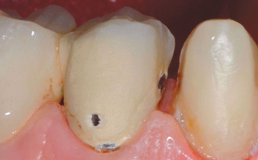 Repair, Don't Replace – Part 1: Resurfacing an Existing Porcelain Fused ...