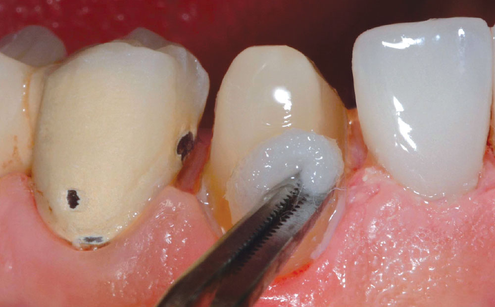 Repair, Don't Replace – Part 1: Resurfacing an Existing Porcelain Fused ...