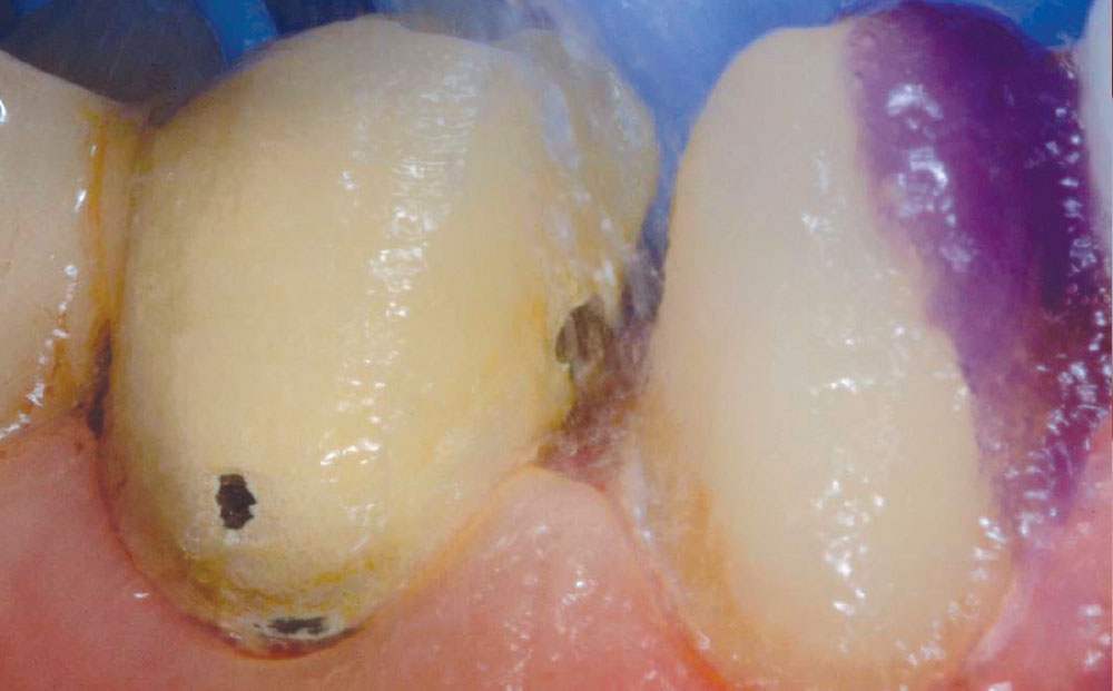 Repair, Don't Replace – Part 1: Resurfacing an Existing Porcelain Fused ...