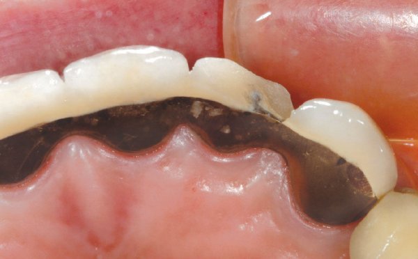 Repair, Don't Replace – Part 2: The Saddle Crown