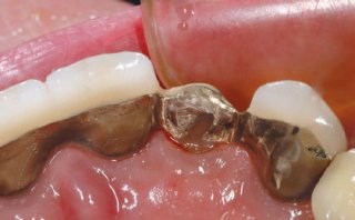 Repair, Don't Replace – Part 2: The Saddle Crown