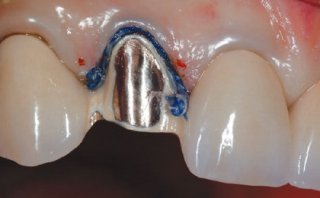 Repair, Don't Replace – Part 2: The Saddle Crown