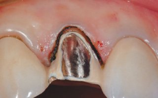 Repair, Don't Replace – Part 2: The Saddle Crown