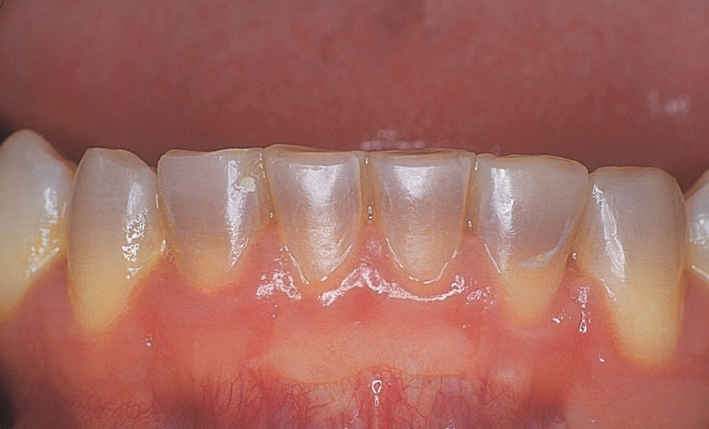 Porcelain Veneers for Tetracycline Using Blockout Method