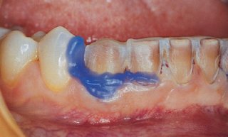 Porcelain Veneers for Tetracycline Using Blockout Method
