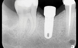 Scannable Abutments: Digital Impressions for Dental Implants