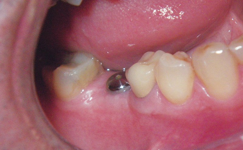 Scannable Abutments: Digital Impressions for Dental Implants