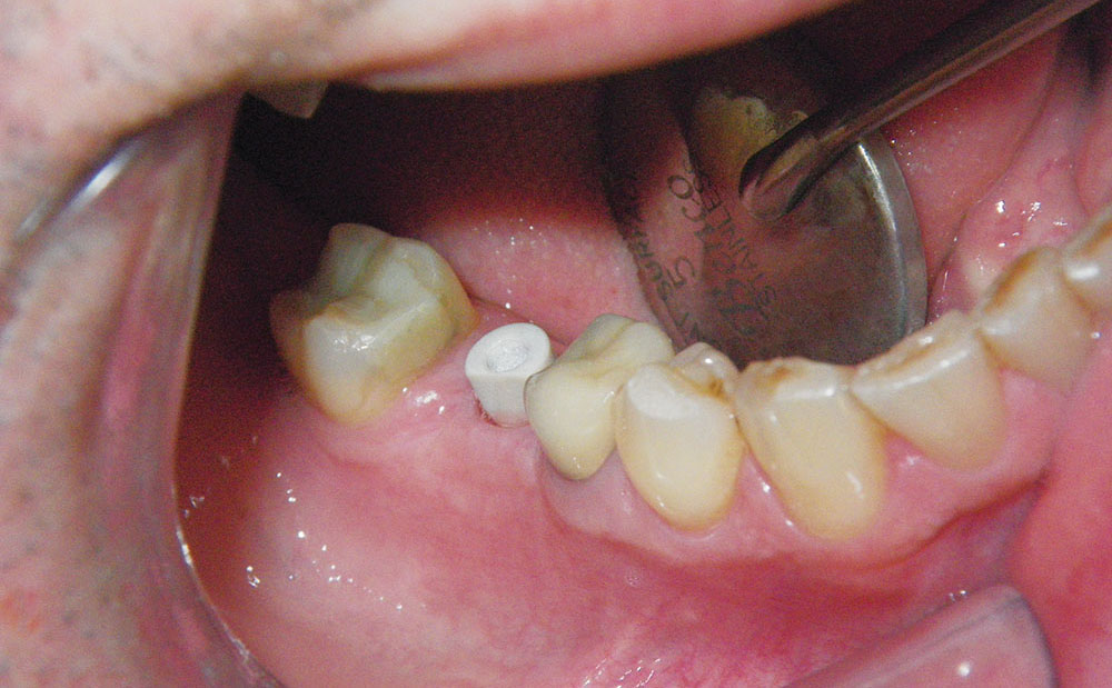 Scannable Abutments: Digital Impressions for Dental Implants
