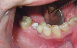 Scannable Abutments: Digital Impressions for Dental Implants