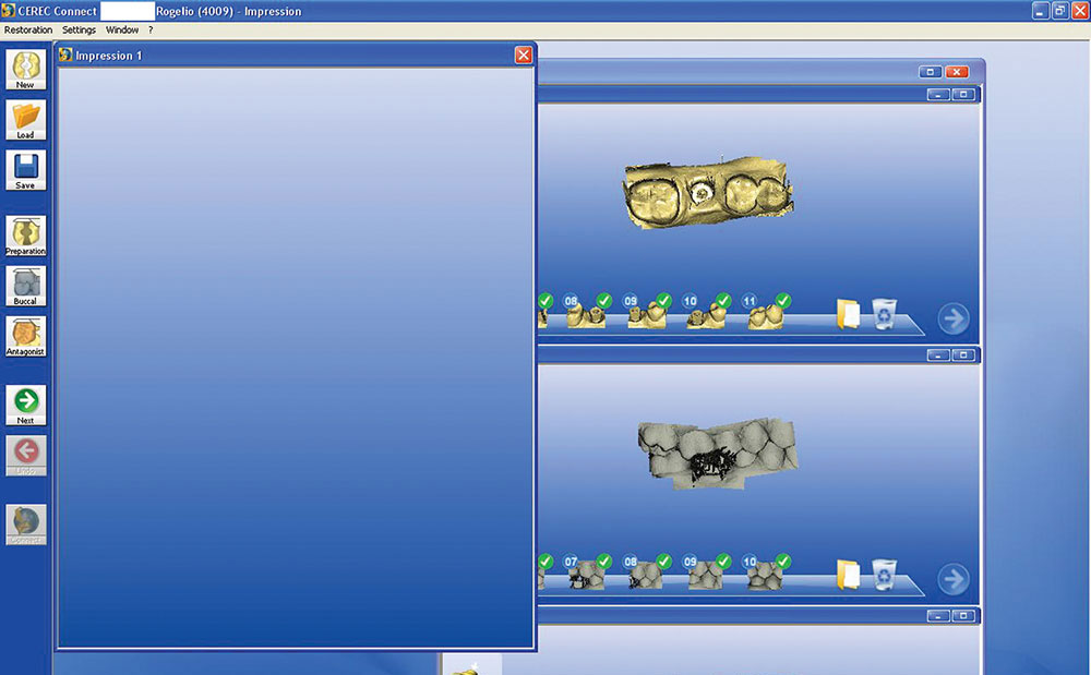 Scannable Abutments: Digital Impressions for Dental Implants