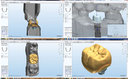 Scannable Abutments: Digital Impressions for Dental Implants