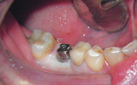 Scannable Abutments: Digital Impressions for Dental Implants