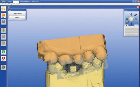 Scannable Abutments: Digital Impressions for Dental Implants