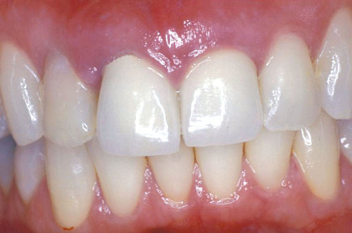 The Creation of a Soft Tissue Emergence Profile with a Long-Term ...