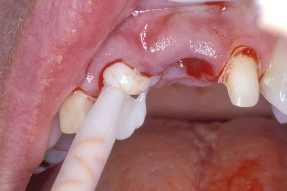 The Creation of a Soft Tissue Emergence Profile with a Long-Term ...