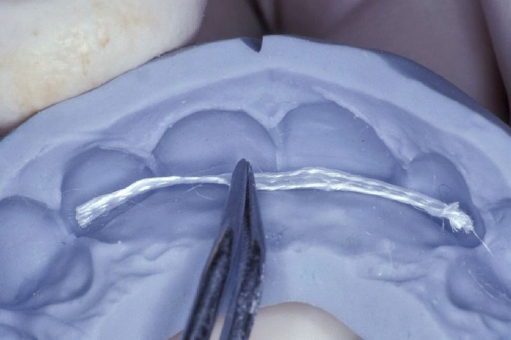 The Creation of a Soft Tissue Emergence Profile with a Long-Term ...