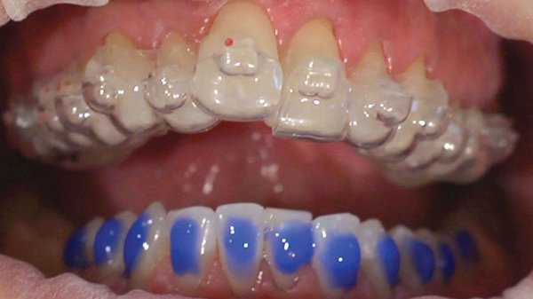 How to Align Teeth in Six Months: Six Month Smiles System Provides ...