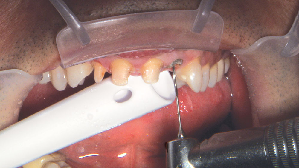 Post-and-Core Technique for Endodontically Treated Teeth