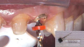 Post-and-Core Technique for Endodontically Treated Teeth