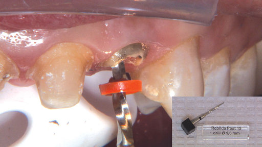 Post-and-Core Technique for Endodontically Treated Teeth