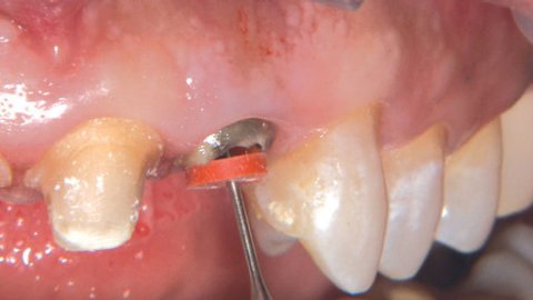 Post-and-Core Technique for Endodontically Treated Teeth