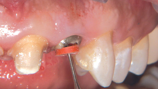 Post-and-Core Technique for Endodontically Treated Teeth
