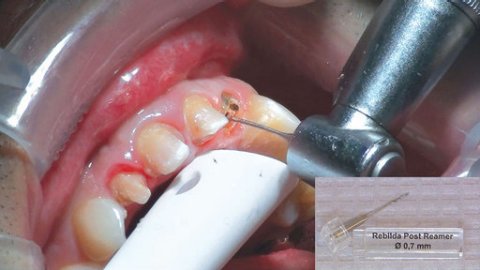 Post-and-Core Technique for Endodontically Treated Teeth