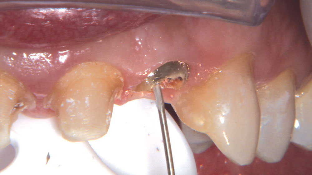 Post-and-Core Technique for Endodontically Treated Teeth