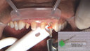 Post-and-Core Technique for Endodontically Treated Teeth