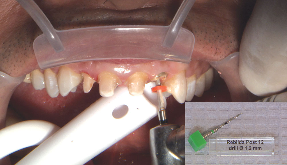 Post-and-Core Technique for Endodontically Treated Teeth
