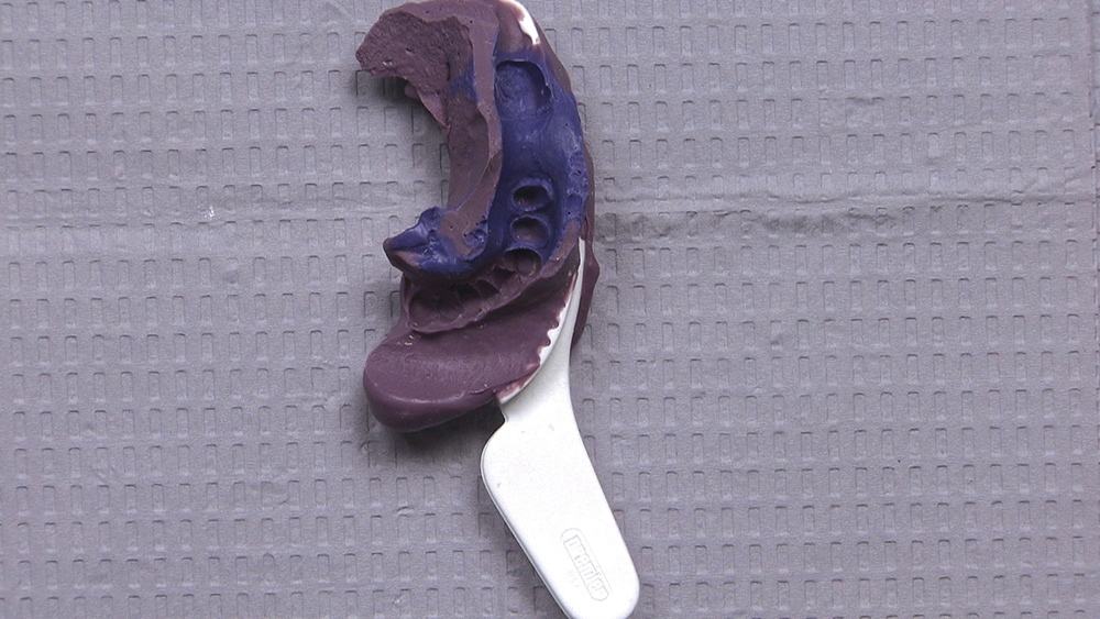 A Disastrous Double-Arch Impression Tray - Case of the Week: Episode 32