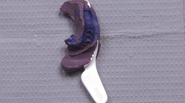 A Disastrous Double-Arch Impression Tray - Case of the Week: Episode 32