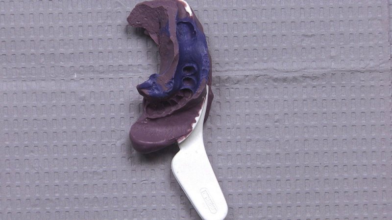 A Disastrous Double-Arch Impression Tray - Case of the Week: Episode 32