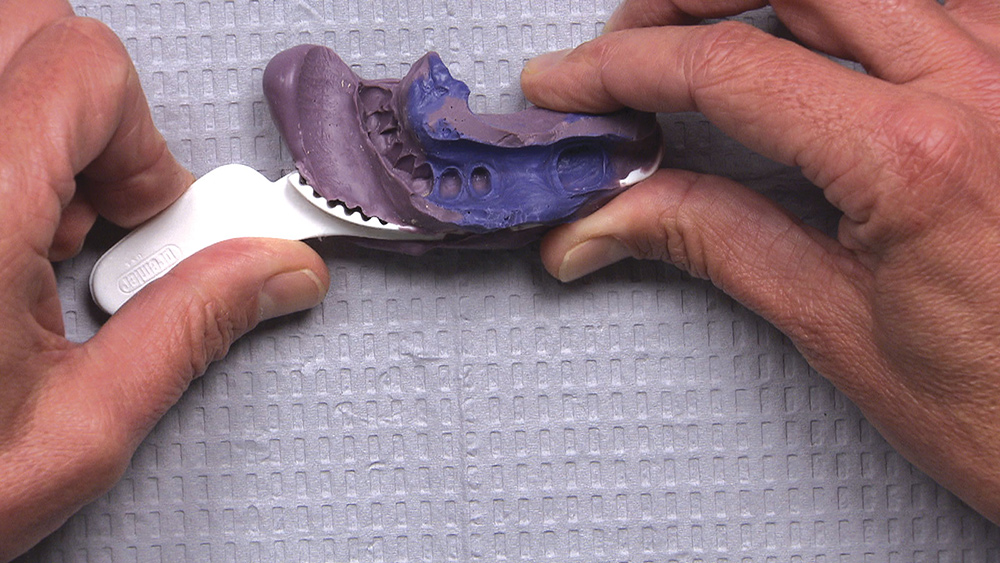 A Disastrous Double-Arch Impression Tray - Case of the Week: Episode 32