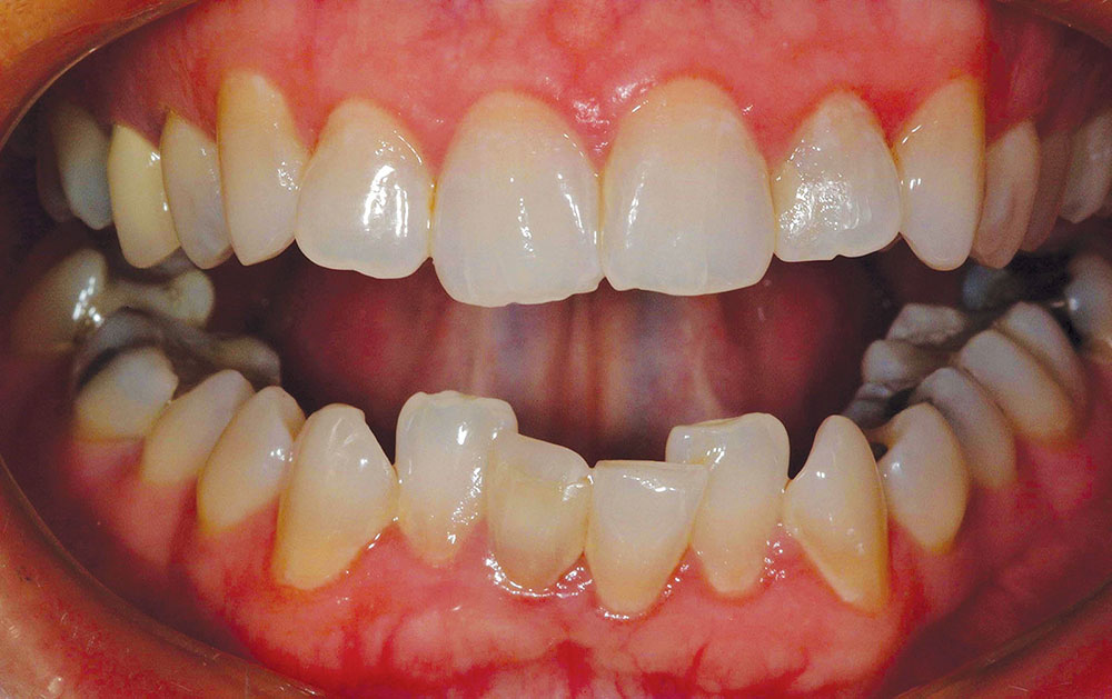 Prosthetic Tooth Repositioning: A Viable Treatment Option for Select Cases
