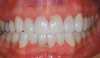 Prosthetic Tooth Repositioning: A Viable Treatment Option for Select Cases