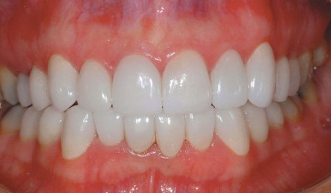 Prosthetic Tooth Repositioning: A Viable Treatment Option for Select Cases