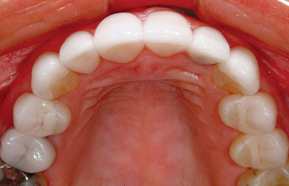 Prosthetic Tooth Repositioning: A Viable Treatment Option for Select Cases