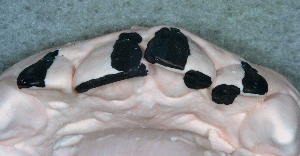 Prosthetic Tooth Repositioning: A Viable Treatment Option for Select Cases